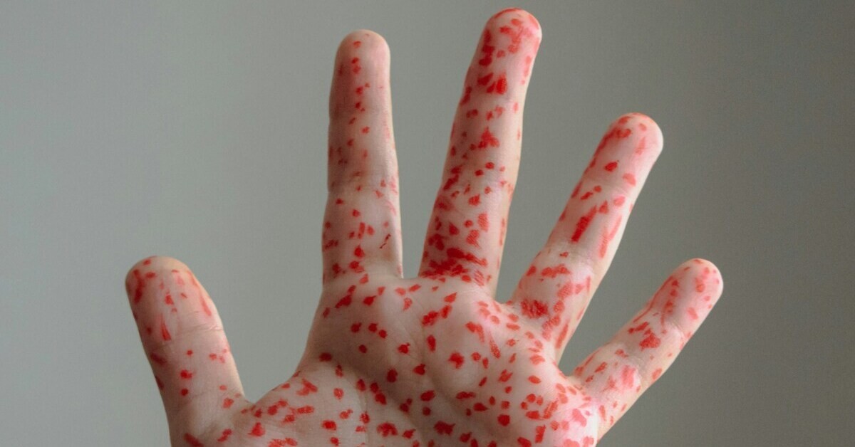 Arten von Ausschlag: Von Punkten und Flecken bis zu roten Quaddeln über ...